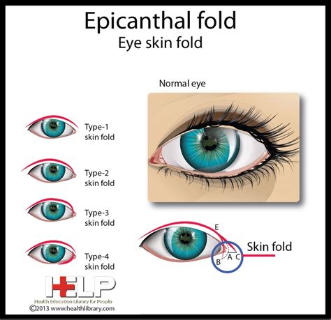 Lack Of Epicanthic Fold