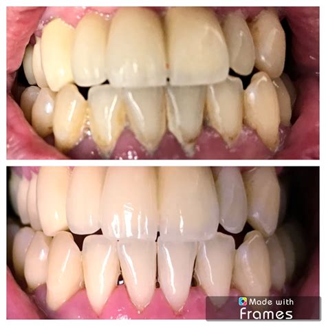 Teeth Cleaning Before And After