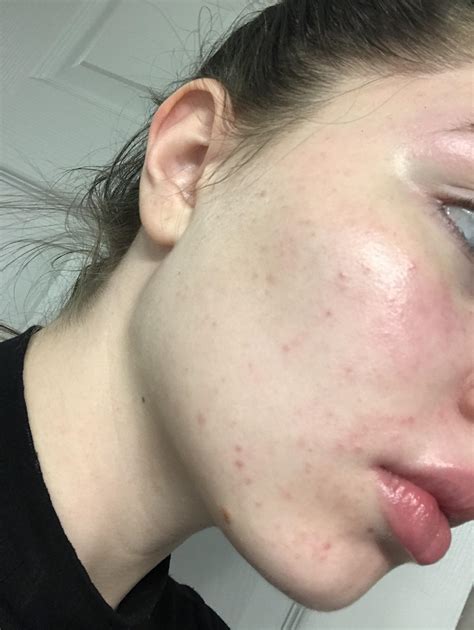 Red Bumps On Face