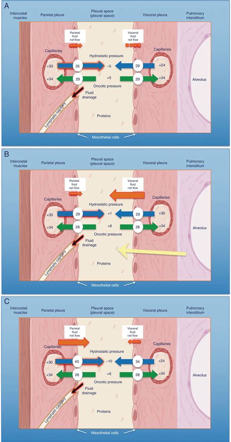 Diagnosis And Management Of Pleural Transudates Archivos De