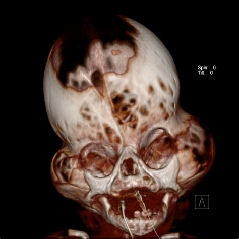Cloverleaf Skull Craniosynostosis Pacs