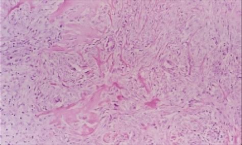Area Showing The Prominent Stromal Desmoplasia Tumoral Cells Arranged