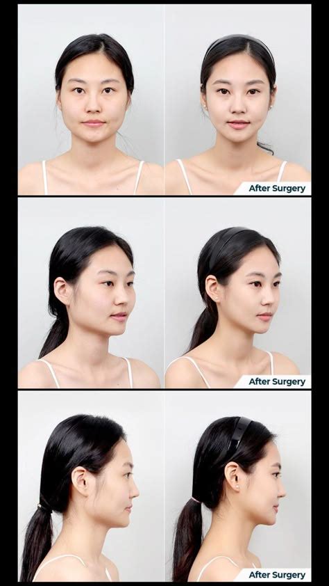 Before And After Cheekbone Reduction Jaw Reduction And Genioplasty