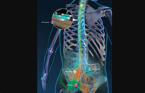 Spinal Cord Stimulation Device Can Make Stroke Patients Regain Movements The Financial Express