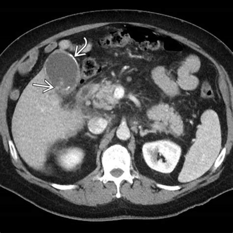Porcelain Gallbladder Clinical Gate