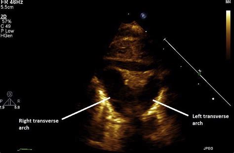 Double Aortic Arch With Atresia Versus Interruption Of Proximal Left