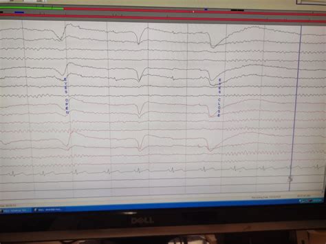 Mahipal Singh Rathore On Linkedin Will Try To Post Few Topics Related To Eeg For The Upcoming