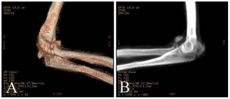 Elbow Fracture Dislocation