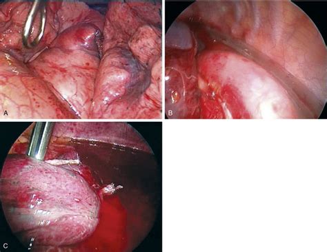 Left Upper Lobe Apical Trisegmentectomy—video 16 1 Clinical Gateclinical Gate