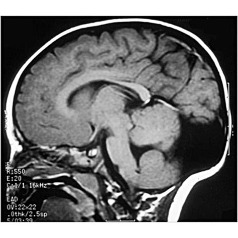 Dandy Walker Malformation Mri