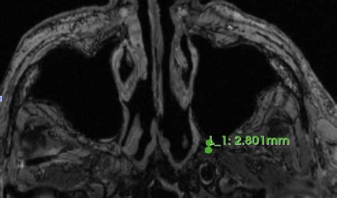 Mri Conditionality — Relief Simplified Neuronoff