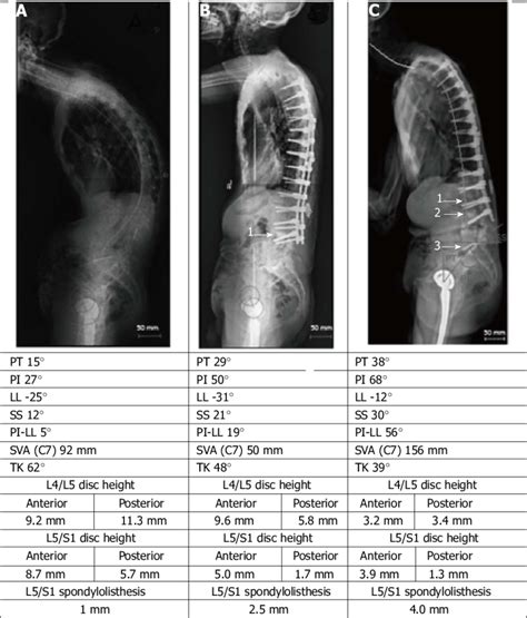 Example Of Distal Segment Degeneration Failure This Event Was