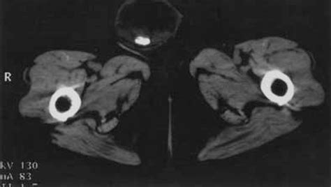 Figure 2 From Laparoscopic Ileus Operation Approached Via Right