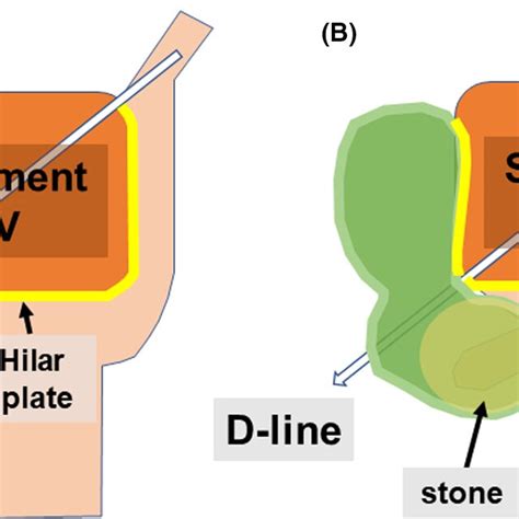 Clinical Application Of The Segment Iv Approach Diagonal Line Of