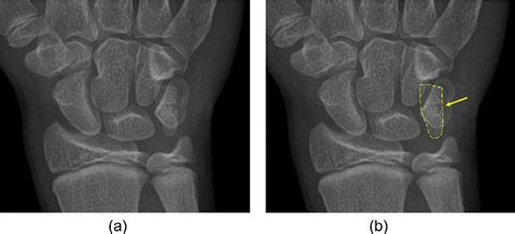 Figure 1 From Hamate Pisiform Coalition Complicated By Fracture In A