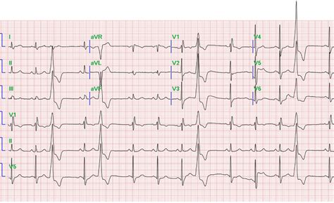 Electrocardiography Of Premature Ventricular Contraction Pvc From
