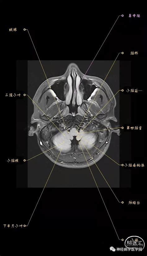 高清颅脑mri解剖 脑医汇 神外资讯 神介资讯
