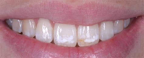 Icon Opalustre Removes Fluorosis Stains Clínica Dental Padrós