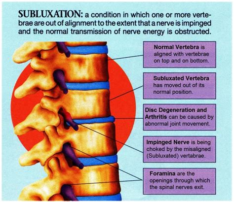 Subluxation Premier Chiropractic Centre