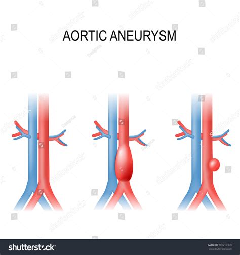 Types Abdominal Aortic Aneurysm Normal Aorta Stock Vector Royalty Free 781219369