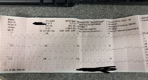 Witnessed Pre Hospital Cardiac Arrest W Rosc Rekgs