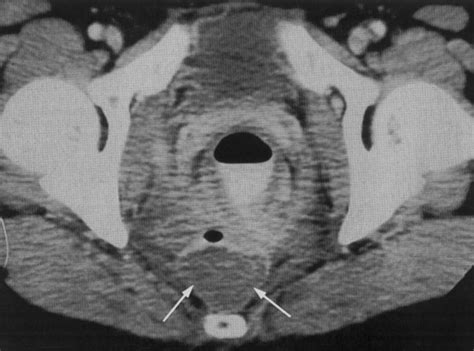 Perirectal Cyst Ct