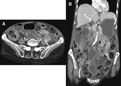 Jejunal Diverticulitis A Single Center Experience And Proposed