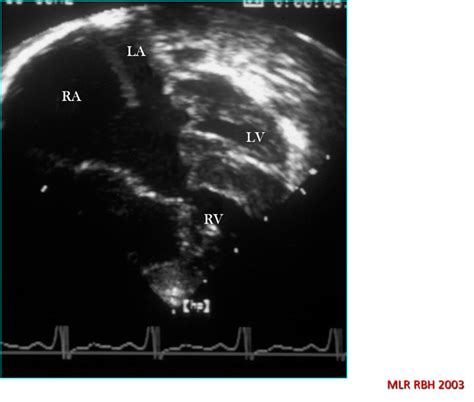 Echocardiographic Four Chamber Section From A Heart With Partial Avsd Download Scientific