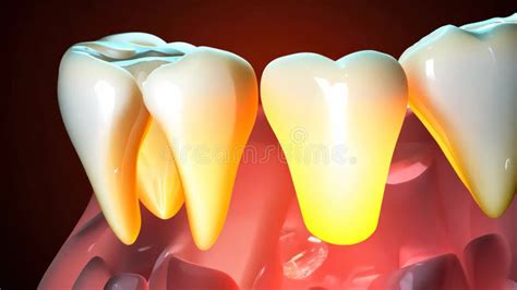 3d Rendering Of Teeth With Inflamed Gums Showing Realistic Textures And