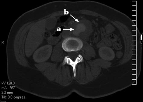 Inflammatory Infrarenal Abdominal Aortic Aneurysm In A Young Woman