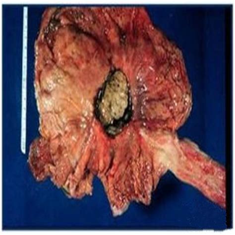 胃窦炎如何治疗有来医生