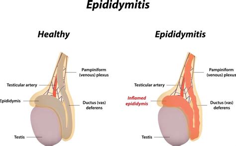 Epididymal Head Cyst