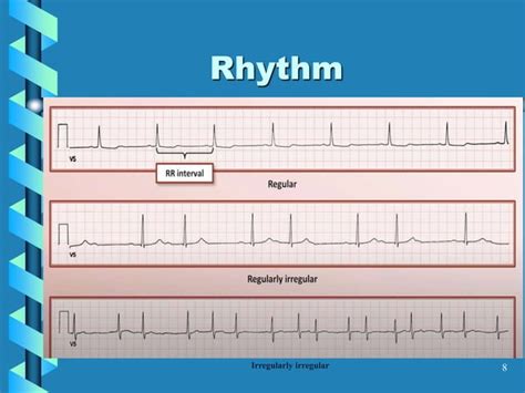 Basic Ecg Interpretation Presentation Ppt