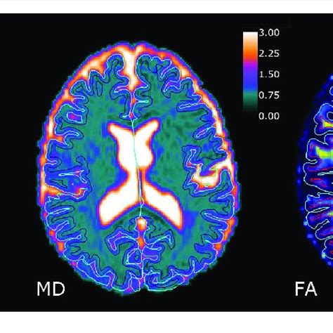 Results Of Diffusion Tensor Imaging Data Processing Single Slice Download Scientific