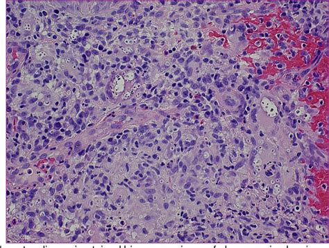 Figure 1 From Primary Cutaneous Cryptococcosis Caused By Cryptococcus