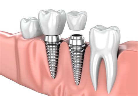Biocompatible Coatings Advancements In Medical Implants And Devices