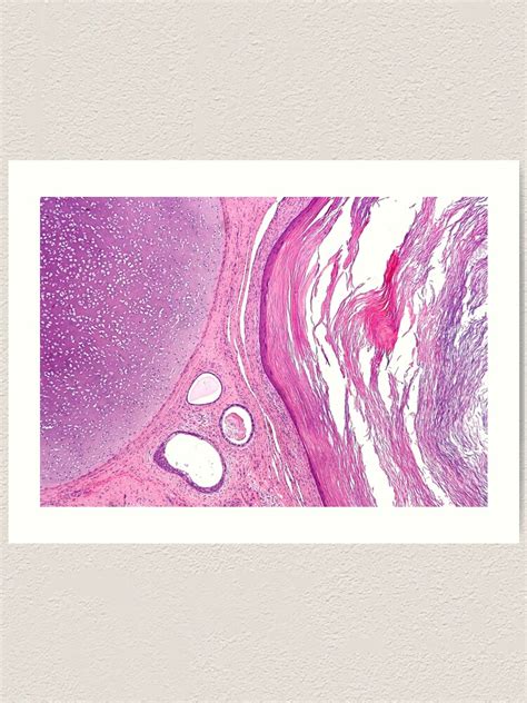 Teratoma Histology Art Print By Deltoid Redbubble