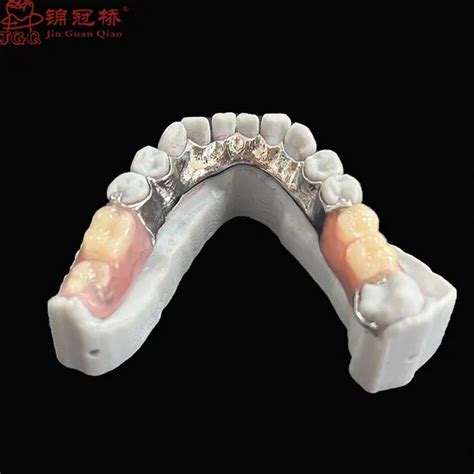 3d Printed Partial Removable Denture Metal Framework For Dental Clinic