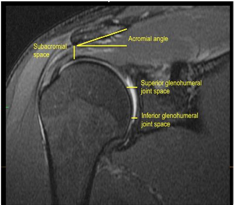 Subacromial Space Radiology