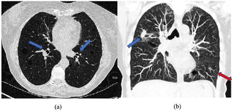 Repeat Chest Ct 14 Months After First Ct In Figure 1 Showing Bilateral Download Scientific