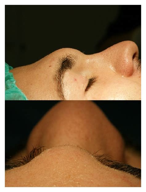 Preoperative Pictures Showing The Mass At The Glabellar Area