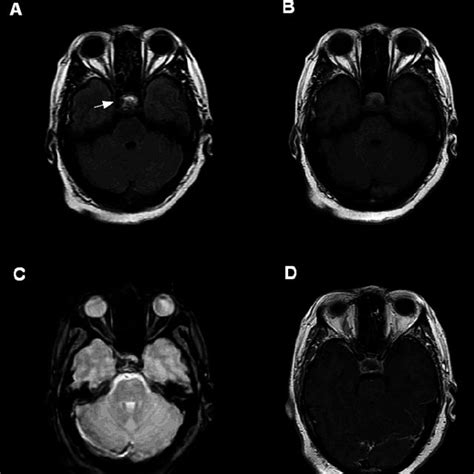 Mri Findings T2 Flair Sequence Showed An Enlarged Sellar Space With A