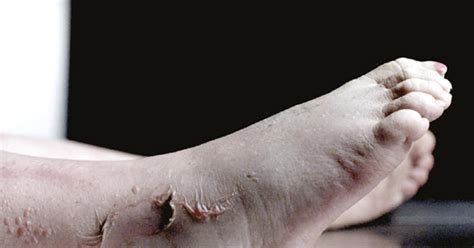 Obesity The Post Mortem Features Broadcast