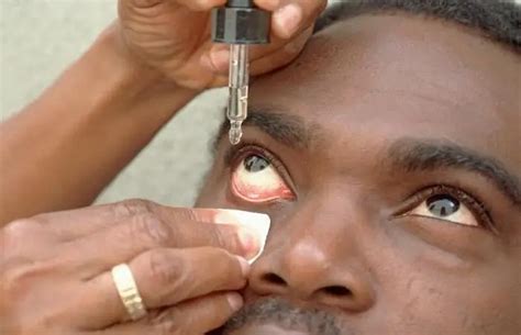 Angular Conjunctivitis Description Of Symptoms With Photos Causes