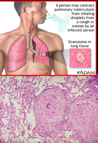 Tuberculosis And Pharmacotherapy Of Mycobacterial Infections Flashcards