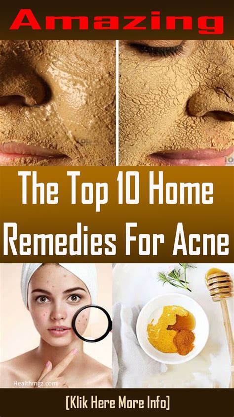 The Top 10 Home Remedies For Acne Healthy Lifestyle