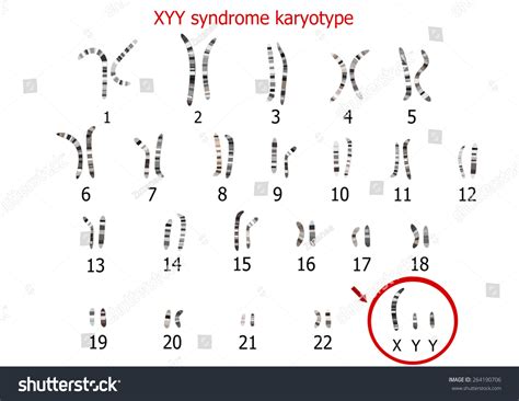 Xyy Chromosome 47xyy Syndrome A Bibliography And Dictionary For