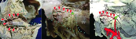 The Atrioventricular Node Artery Originating From The Distal Download Scientific Diagram