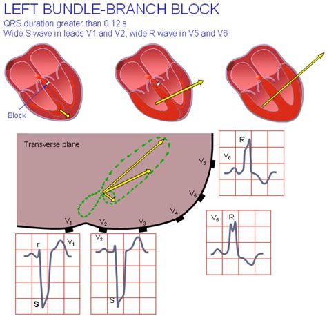 Left Bundle Brach Block Lbbb