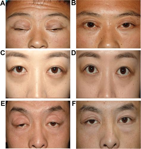 Surgical Effects In Patients With Clinical Manifestations Of